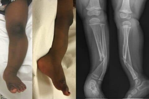 Congenital Pseudarthrosis of the Tibia - LLRS