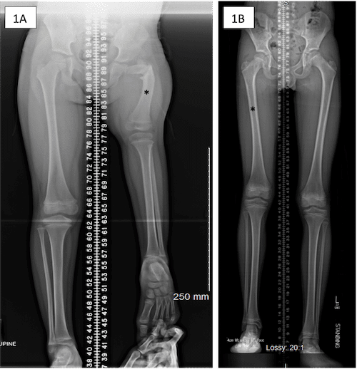 Congenital Femoral Deficiency (Proximal Femoral Focal Deficiency and ...