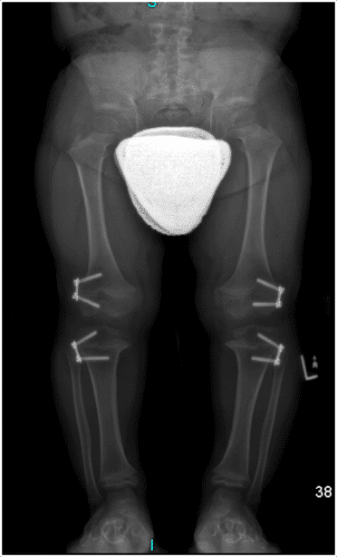 Key Techniques: Hemiepiphysiodesis (Guided Growth) - LLRS