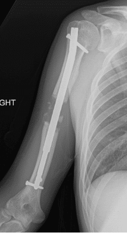 Key Techniques: Bone lengthening with an Internal Lengthening Nail - LLRS