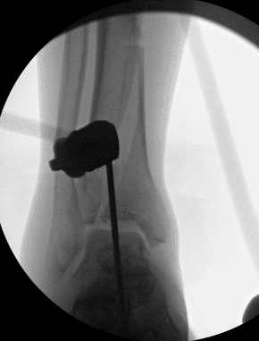 Pilon Fractures - LLRS