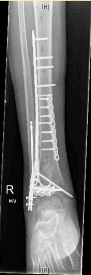 Pilon Fractures - LLRS