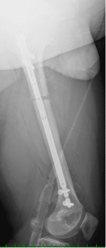 Key Techniques: Bone lengthening with an Internal Lengthening Nail - LLRS