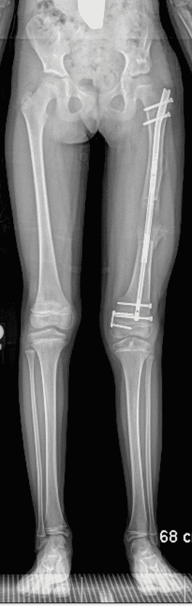 Key Techniques: Bone lengthening with an Internal Lengthening Nail - LLRS