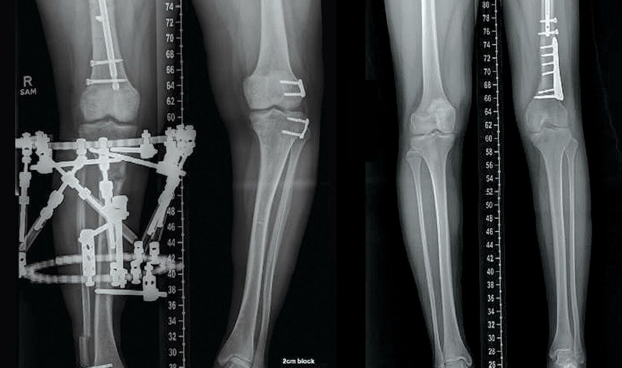 UCSF Managing Children with Lower Limb Differences: Local to Global - LLRS